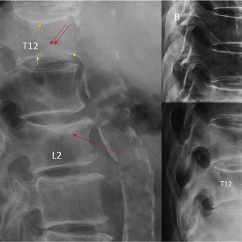Classification Of Vertebral Fractures By The Genants Semi Quantitative