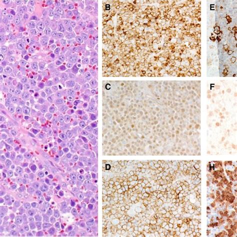 Diffuse Large B Cell Lymphoma With Secretorypartial Plasmablastic