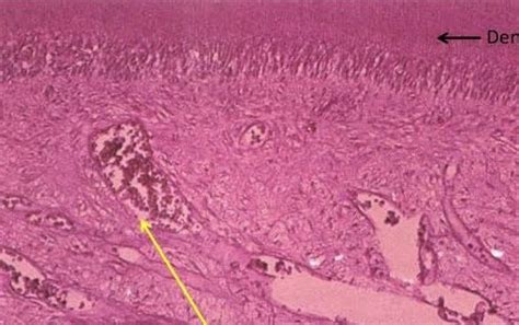 Focal Reversible Pulpitis Dentistry Beef