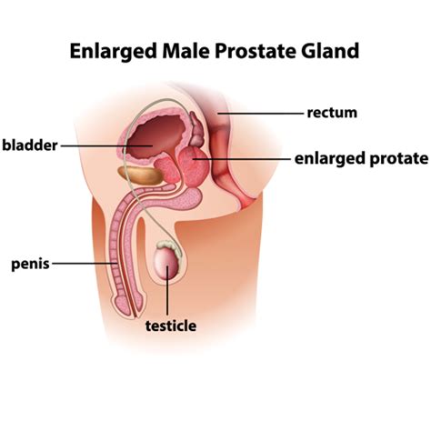 Benign Prostatic Hyperplasia
