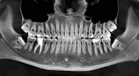 Wisdom Teeth Removal For Bite Correction In Dubai Polar Bear General