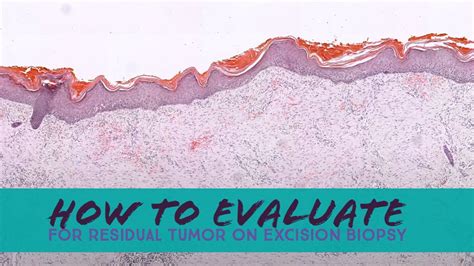 How To Examine Skin Cancer Excision Specimen After Biopsy To Evaluate For Residual Tumor Youtube