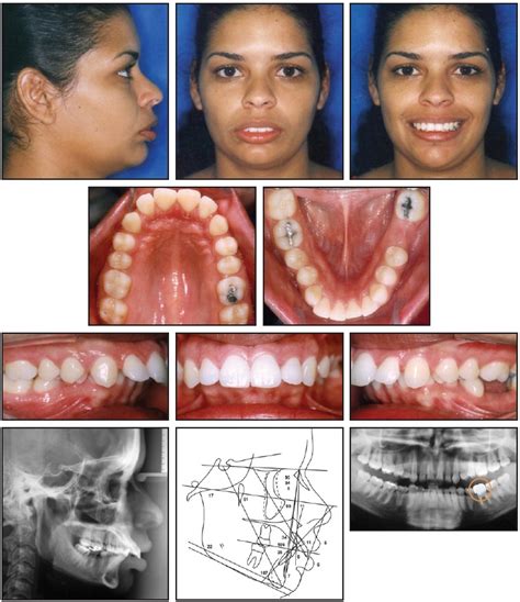 Class Ii Malocclusion Deep Orthodontic Treatment For Class Ii Division