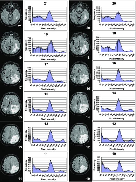 Mri Sequences Chart Lumbar Spine Protocol Mri Snte