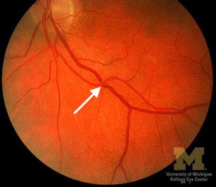 Copper Wiring And Silver Wiring Ophthalmoscopic Abnormalities The