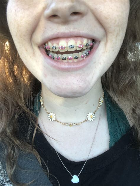 6 Months R Braces