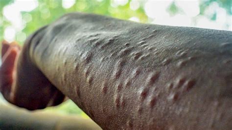 Poison Oak Rash Pictures And Remedies Poison Ivy Rash Poison Oak