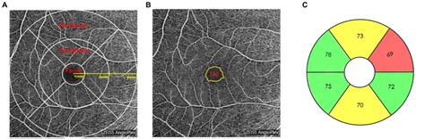 A Macular Superficial Vessel Density And Perfusion Density