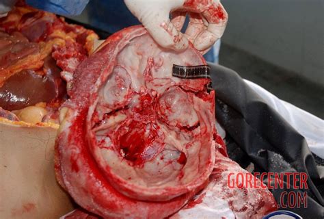 Autopsy Of Brain After Stroke • Gorecenter