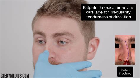 Nasal Bone Technique