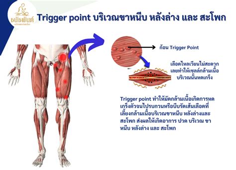 ปวดขาหนบราวลงขา นวดสลาย Trigger Point พงผด ชวยได เหนผลจรง