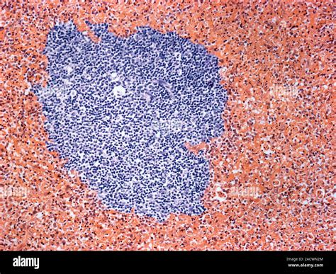 Kikuchi Fujimoto Disease Light Micrograph Of A Section Through A Lymph Node Of A Patient With