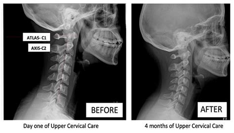 Upper Cervical Subluxation