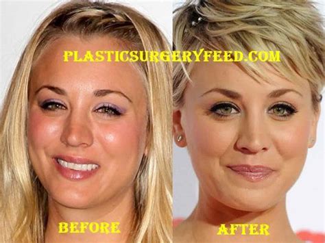 Kaley Cuoco Plastic Surgery Was Done At The Age Of Vrogue Co