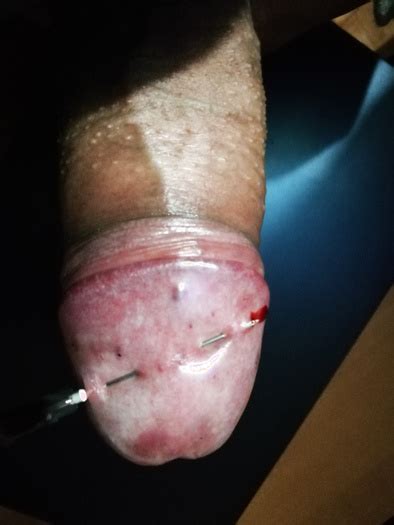 Painful Needles Cbt Image Thisvid Tube