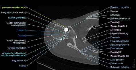 Artrografía Del Hombro Anatomía Normal E Anatomy