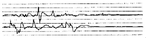 Electrical Activity In A Man With Erectile Dysfunction After Pelvic Download Scientific Diagram