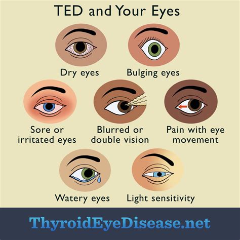 How Are The Eyes Affected By Thyroid Eye Disease Ted