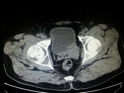 前列腺癌伴骨转移内分泌治疗 医联