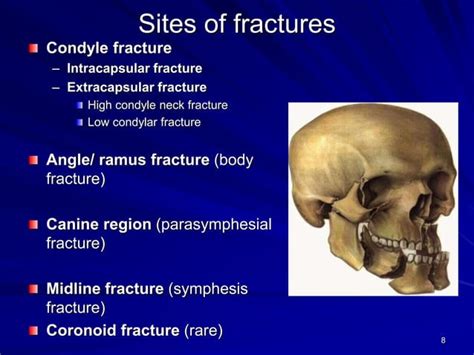 268307418 Management Of Mandibular Fractures Ppt Ppt