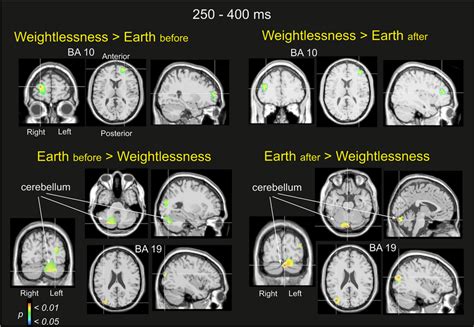 Sources Estimations During The P300 Component 250 400 Ms Period Download Scientific Diagram