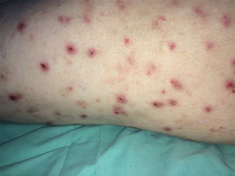 Serlopitant Benefits Patients With Treatment Refractory Prurigo