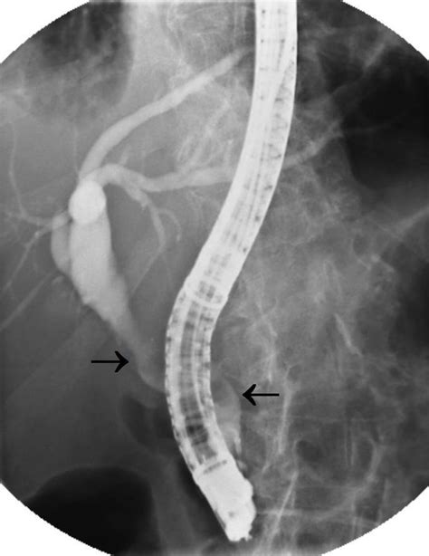 Ercp With Multiple Biliary Duct Stones Download Scientific Diagram