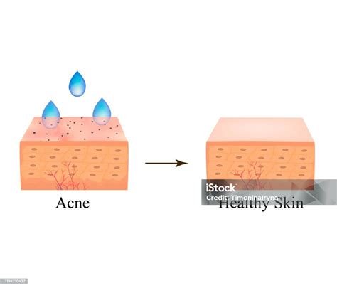 산 박리여드름 치료 피부에 블랙 헤드의 검은 반점 여드름 블랙 모공 클렌징 여드름이있는 피부의 해부학 적 구조 격리된 배경에 대한 벡터 그림입니다 각질제거에 대한 스톡 벡터