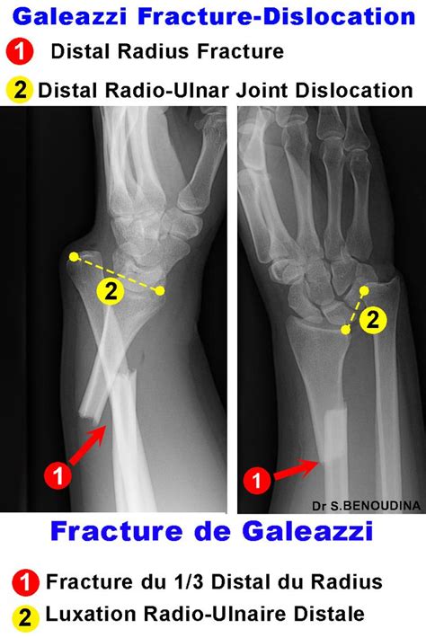 Galeazzi Fracture Classification