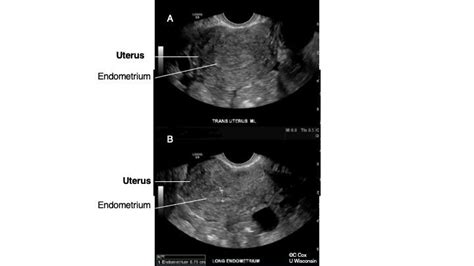 Uterus