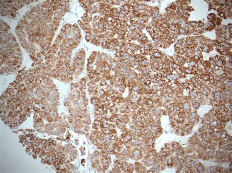 Pathology Outlines Hepatocellular Carcinoma Overview