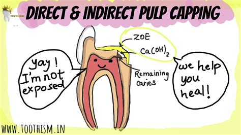 Direct And Indirect Pulp Capping Vital Pulp Therapy Pediatric Dentistry Youtube
