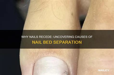 Why Nails Recede Uncovering Causes Of Nail Bed Separation Nailicy
