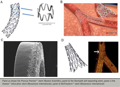 Angina Module 7 Revascularisation In Stable Coronary Artery Disease
