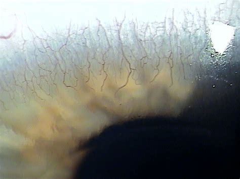 Corneal Neovascularization This Is A Photo Of Corneal Neov… Flickr Photo Sharing