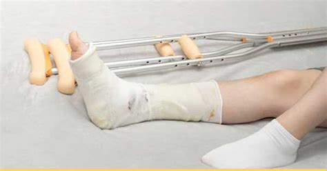 What Is Transverse Fracture Klarity Health Library