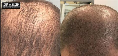 Covering Head Scars With Scalp Micropigmentation Smp Of Austin