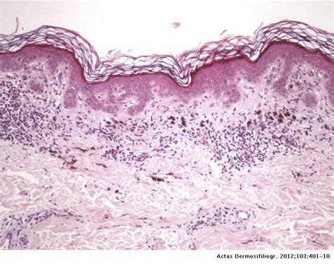 Complete Regression Of Melanocytic Nevi Correlation Between Clinical Dermoscopic And