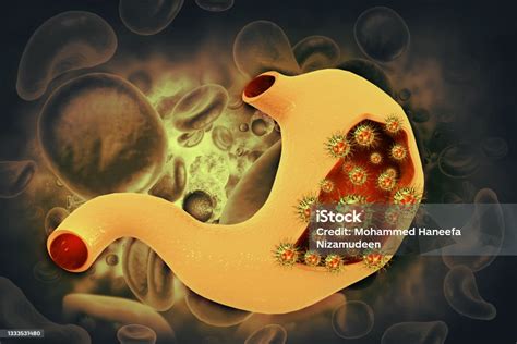 바이러스와 박테리아와 인간의 위장 위암 3d 일러스트레이션 복부에 대한 스톡 사진 및 기타 이미지 복부 위 종양 Istock