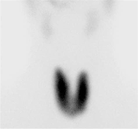 99mtc Scintigraphy Diffuse Uptake In The Thyroid Gland Was Revealed
