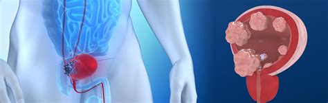 Malignant Tumor Of The Bladder Bladder Cancer Comprehensive Guide To Symptoms Causes And