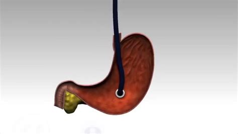 Enrique De Madaria On Linkedin 3d Model Of An Endoscopic Necrosectomy In Acute Pancreatitis