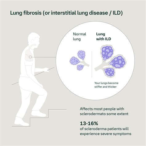 Lung Problems In Systemic Sclerosis More Than Scleroderma