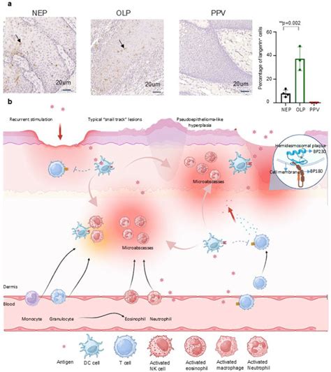 Pyodermatitis Pyostomatitis Vegetans The Role Of Langerin Deficiency In Disease Pathogenesis Pmc
