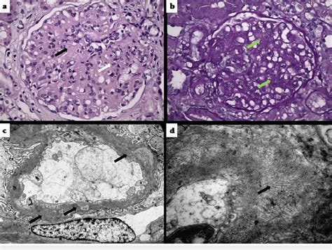 A Mild To Moderate Mesangial Expansion Black Arrow With Mesangial Download Scientific
