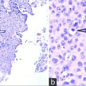 A Keratinization Of Individual Horn Squamous Cell Carcinoma Scc