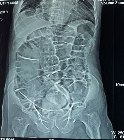 General Surgery Clinics ~ A Surgeons Blog Colonic Pseudo Obstruction