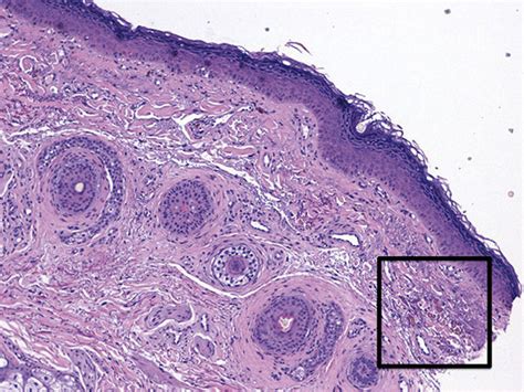 Patchy Facial Hyperpigmentation Actas Dermo Sifiliográficas