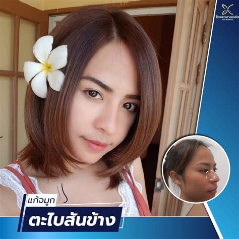 ถอยจมูกใหม่ 👃 เสริมจมูก เอเชียคลีนิก หมอทนงศักดิ์