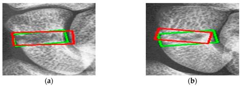 The Detection And Classification Of Scaphoid Fractures In Radiograph By Using A Convolutional